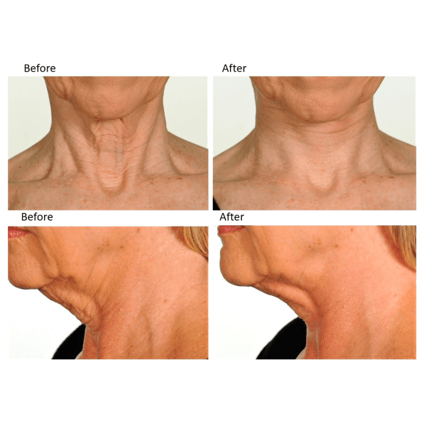 MorningSave: 120-Pack: Contours Rx NECK RESCUE Non-Surgical Correcting ...