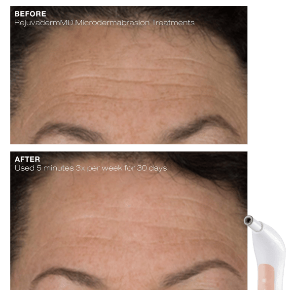 MorningSave: Trophy Skin RejuvadermMD Microdermabrasion Device