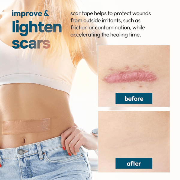 MorningSave: 2-Pack: AllSett Health Silicone Scar Tape