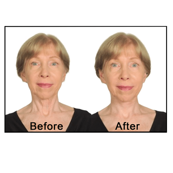 MorningSave: 120-Pack: Contours Rx NECK RESCUE Non-Surgical Correcting ...